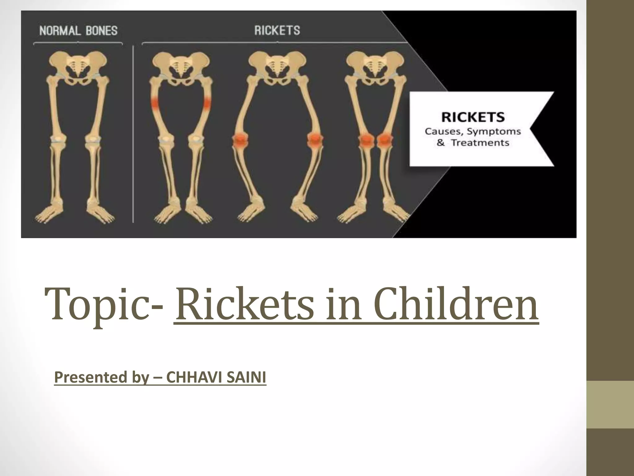 Topic- Rickets in children by Chhavi Saini | PPTX