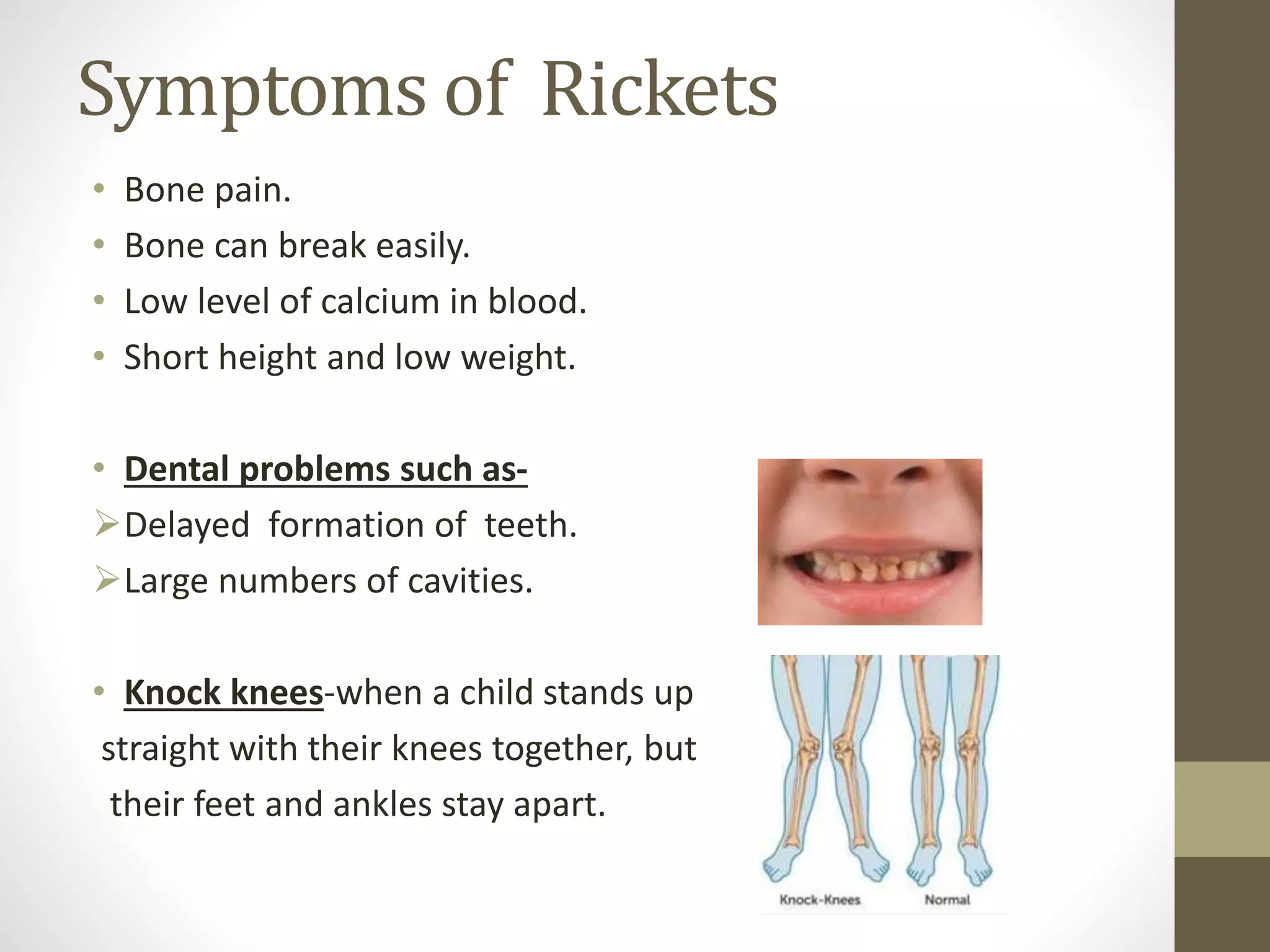Topic- Rickets in children by Chhavi Saini | PPTX