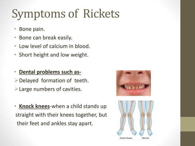Topic- Rickets in children by Chhavi Saini | PPTX