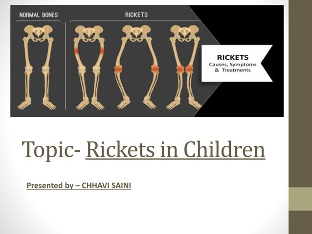 Topic- Rickets in children by Chhavi Saini | PPT