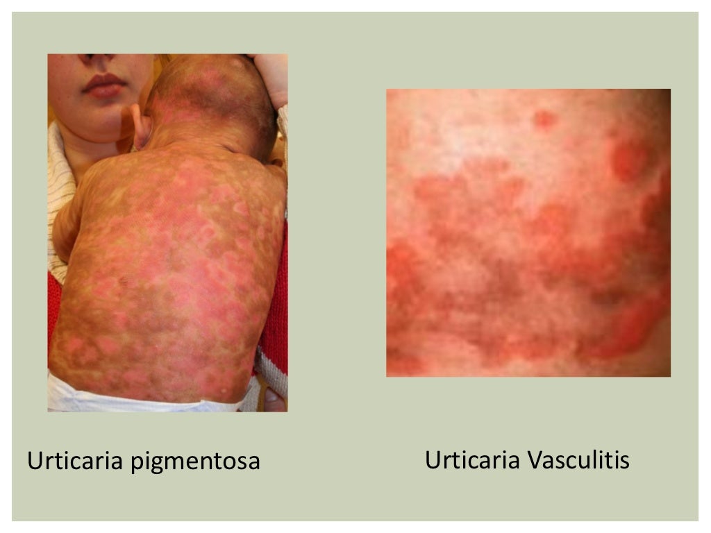Topic urticaria, angioedema and anaphylaxis final