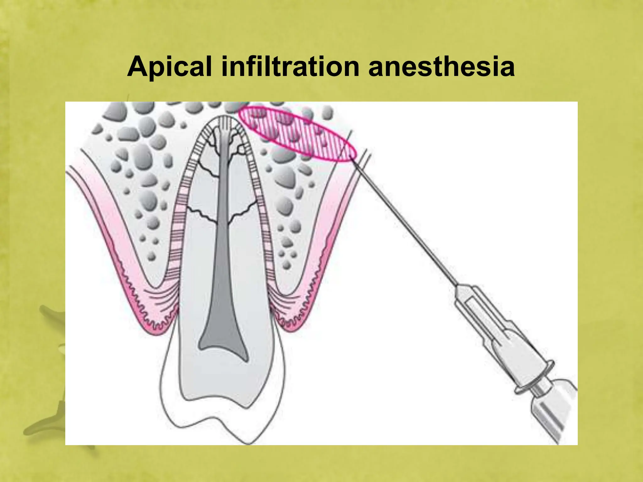 local anesthesia in dentistry definition of terms and indications and ...