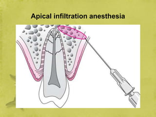 local anesthesia in dentistry definition of terms and indications and ...