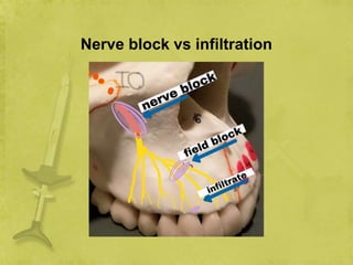 local anesthesia in dentistry definition of terms and indications and ...