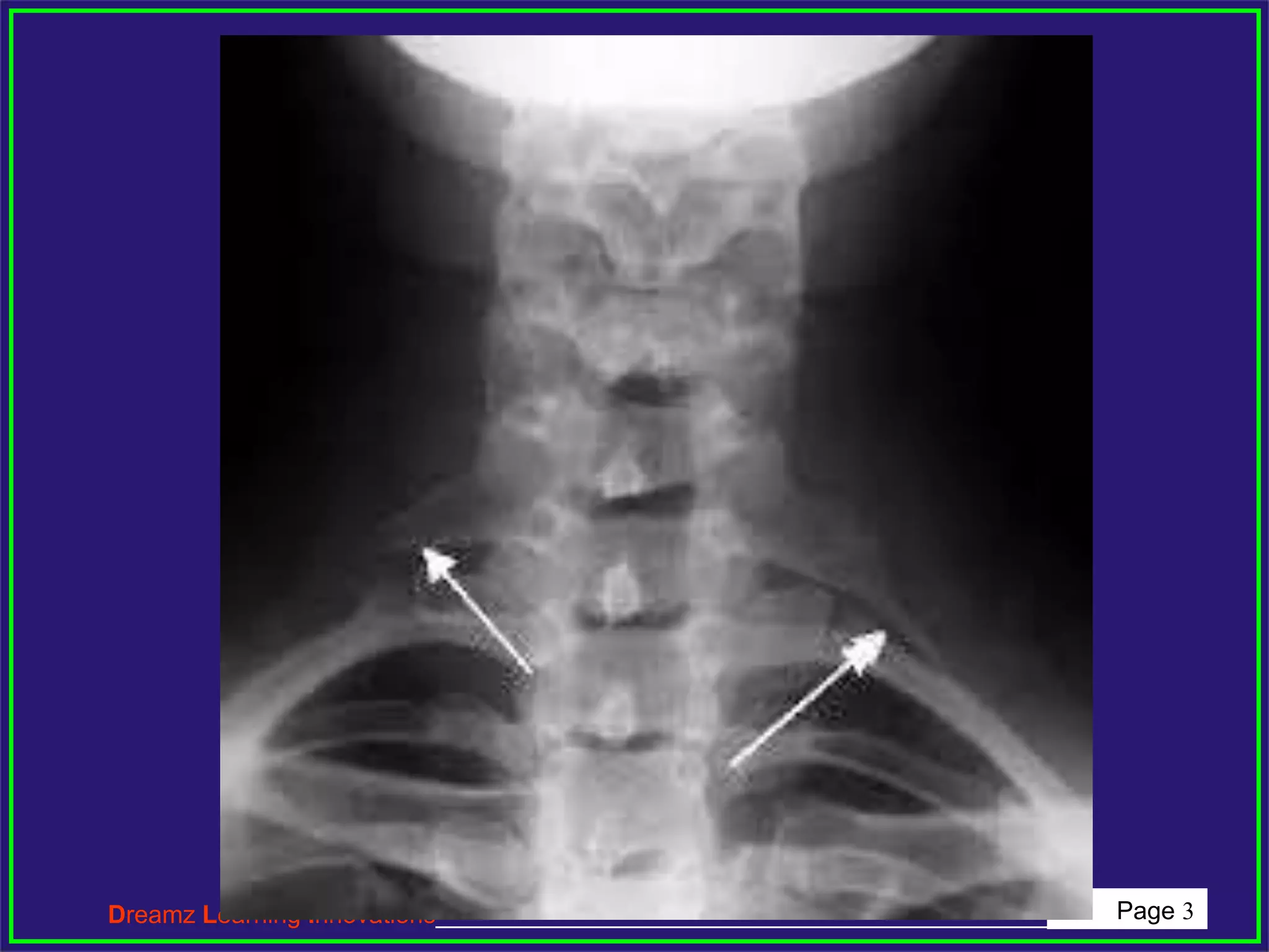 Topic 60 CERVICAL RIB.ppt