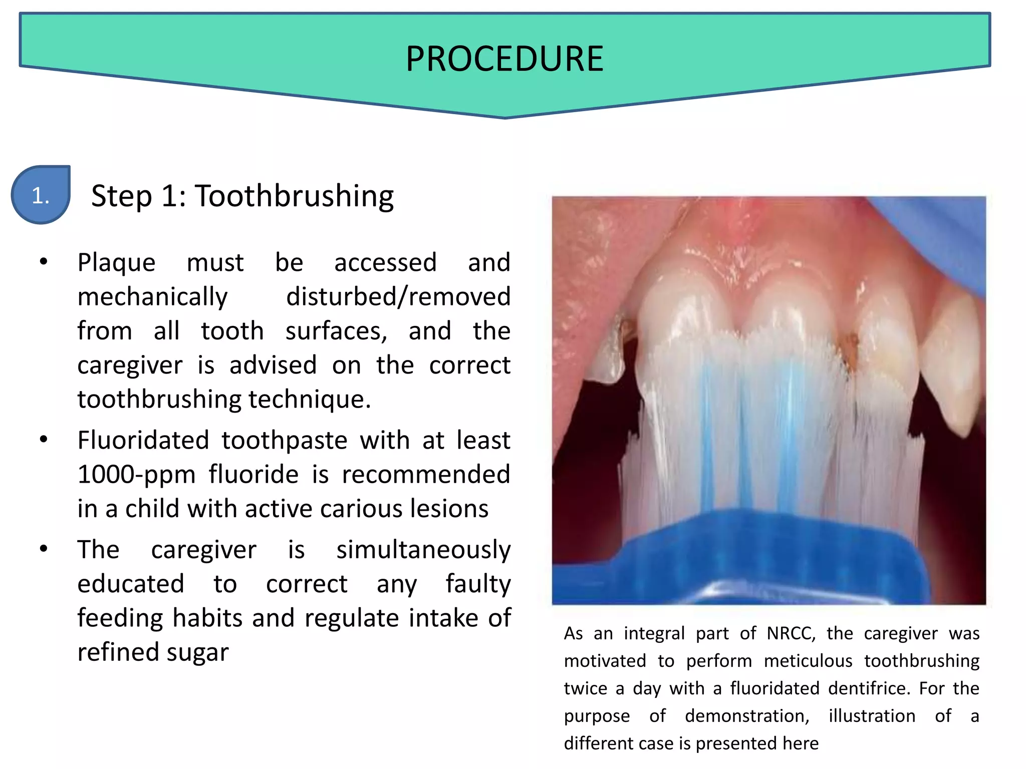 TOPICAL APPLICATION FLUORIDE.pptx