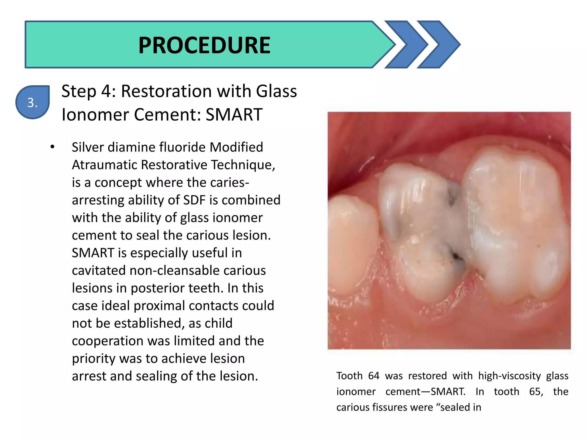 TOPICAL APPLICATION FLUORIDE.pptx