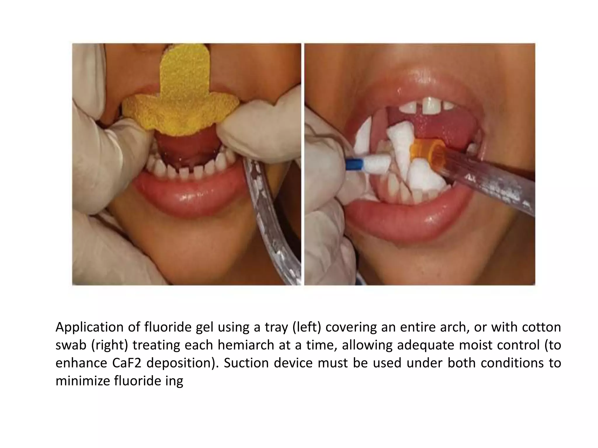 TOPICAL APPLICATION FLUORIDE.pptx