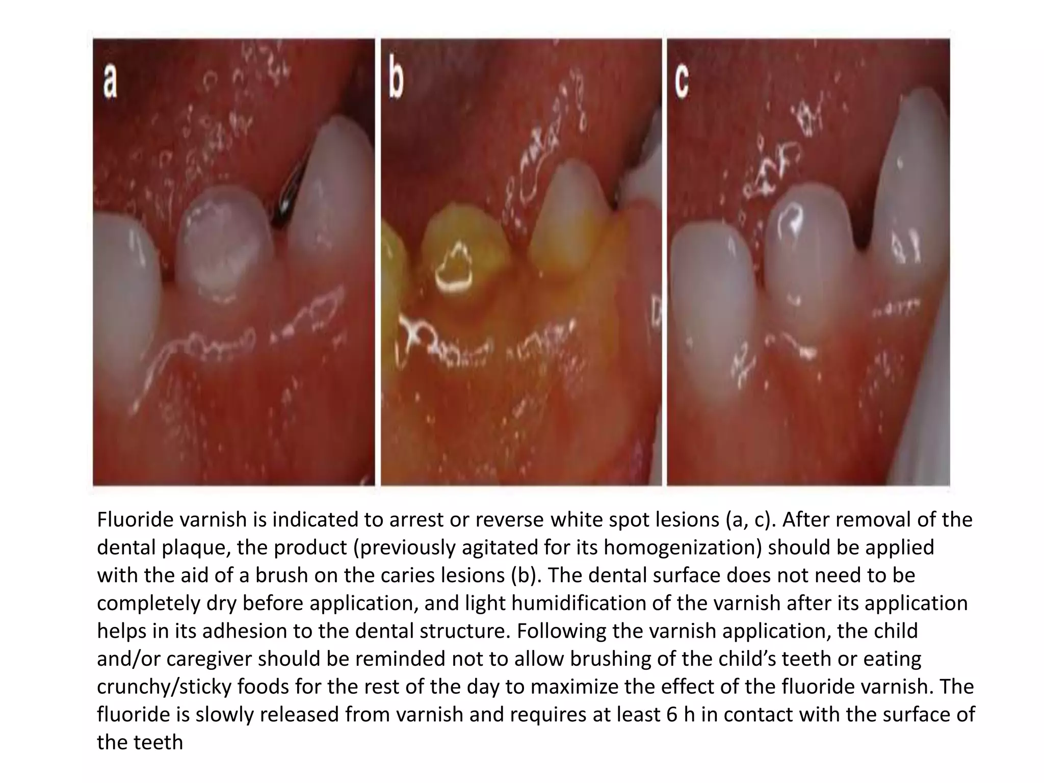 TOPICAL APPLICATION FLUORIDE.pptx