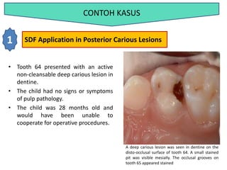 TOPICAL APPLICATION FLUORIDE.pptx
