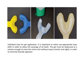 TOPICAL APPLICATION FLUORIDE.pptx