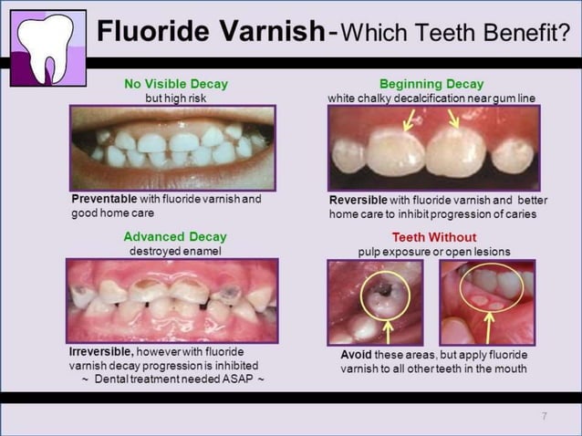 Topical application of fluoride.pptx | Oral care | Personal Care