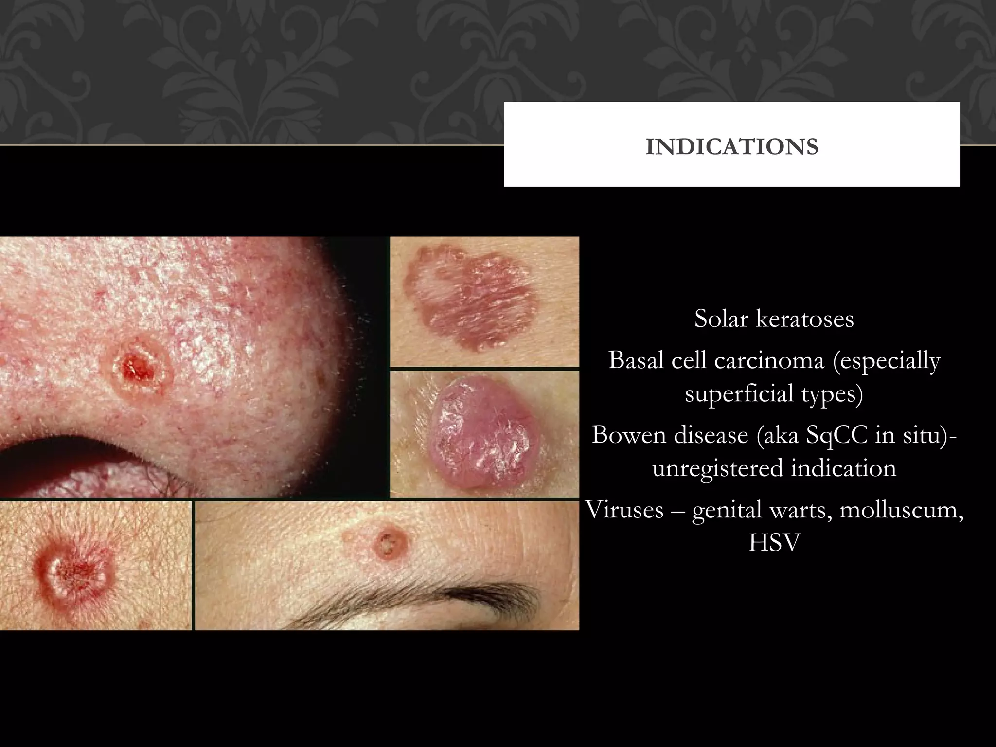 Topical chemo therapeutic treatments for non melanoma skin cancer | PPT ...