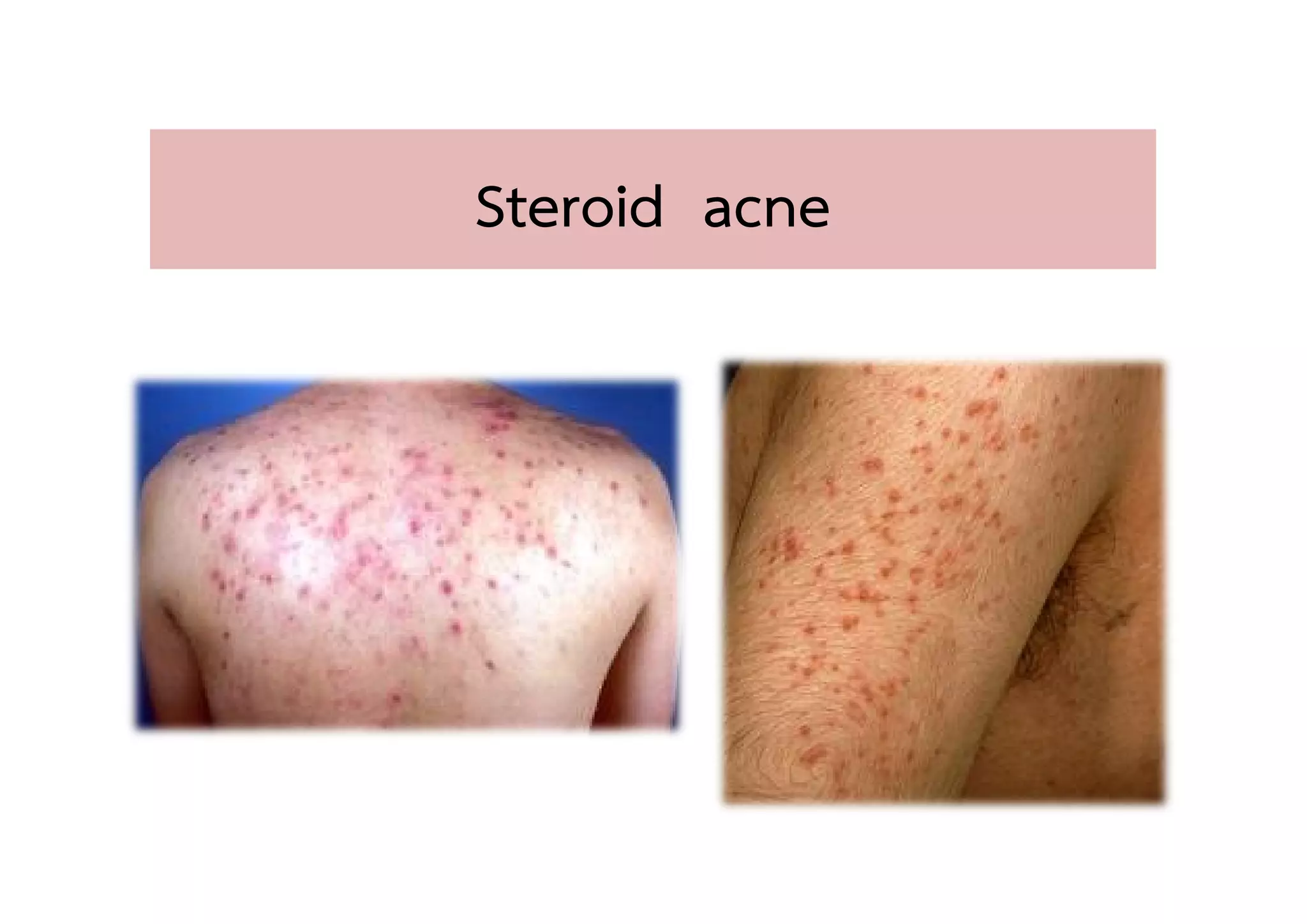 Topical corticosteroids | PDF