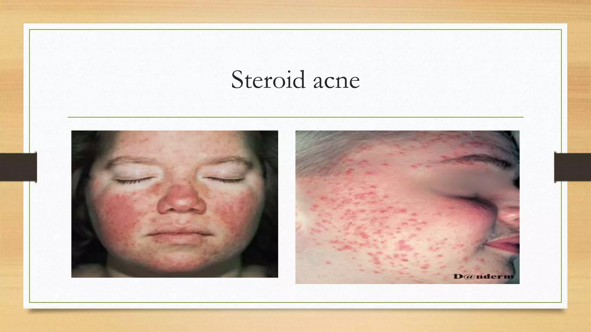 Topical corticosteroids | PPTX