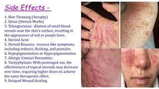 Topical corticosteroids and their uses , applications ...