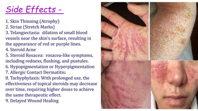 Topical corticosteroids and their uses , applications ...