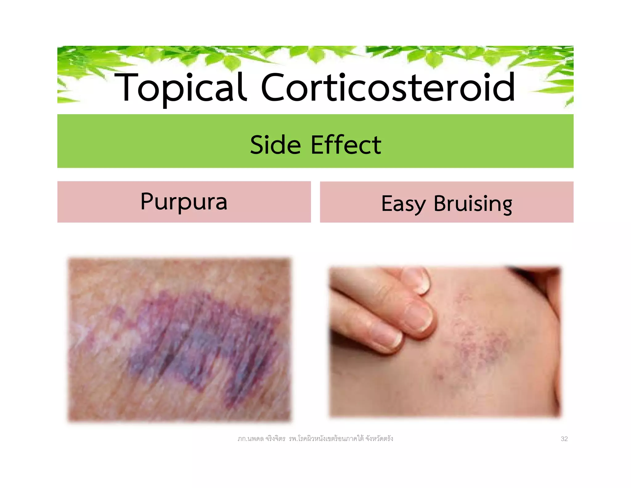 Topical corticosteroids | PDF