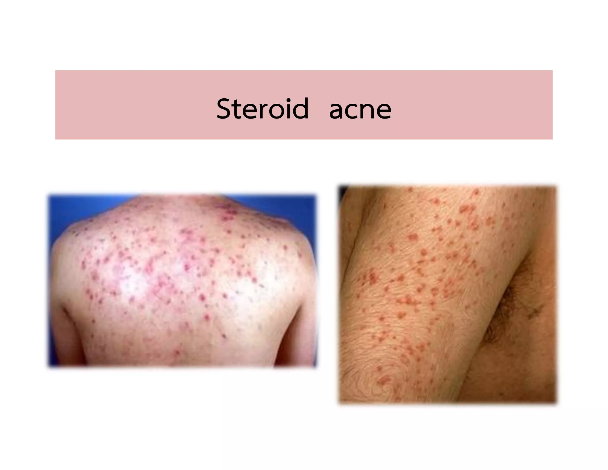 Topical corticosteroids | PPT