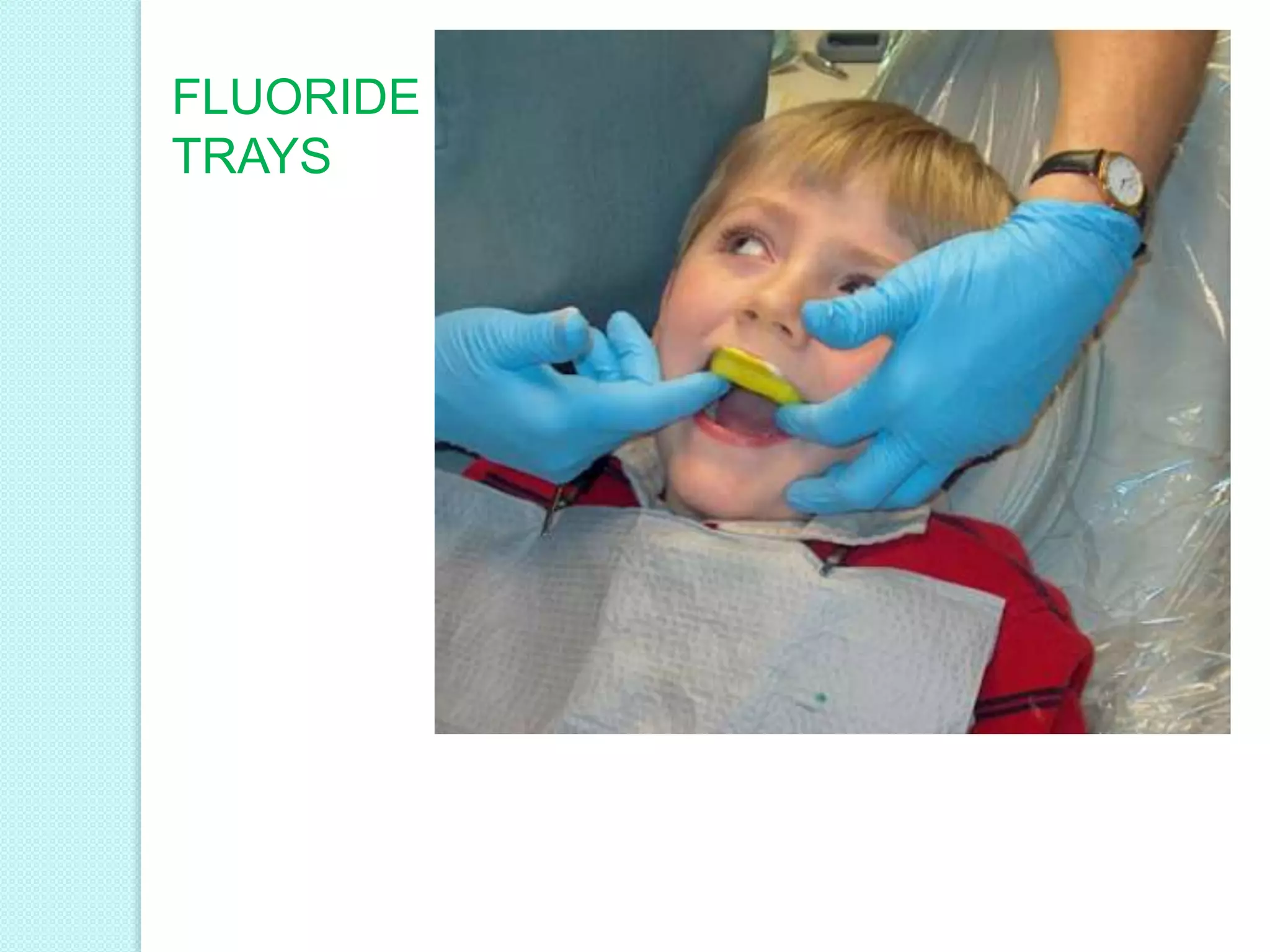 Topical fluorides in dentistry | PPTX