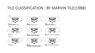 TOPIC –CLASSIFICATION OF PELVIC FRACTURE.pptx