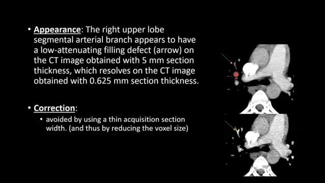 TOPIC – CT ARTEFACTS about imp artefacts.pptx
