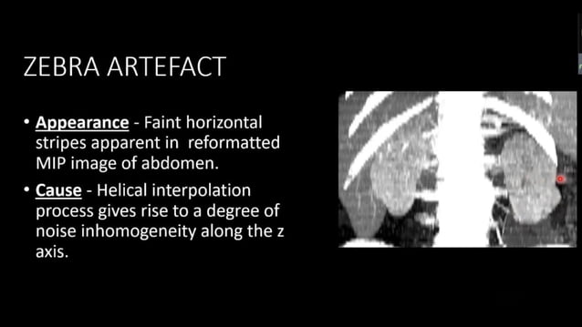 TOPIC – CT ARTEFACTS about imp artefacts.pptx