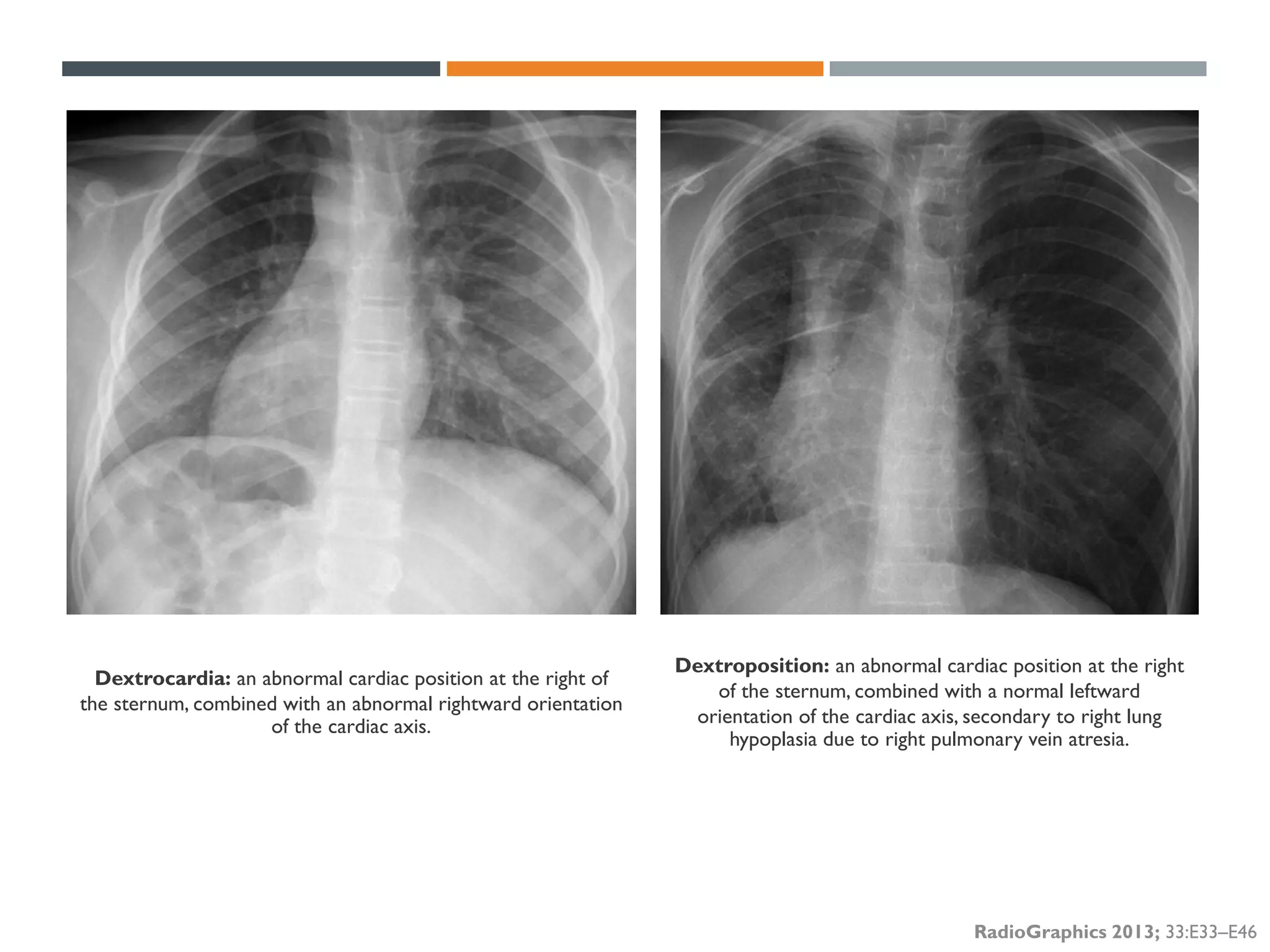 Segmental approach to Congenital Heart Disease | PDF