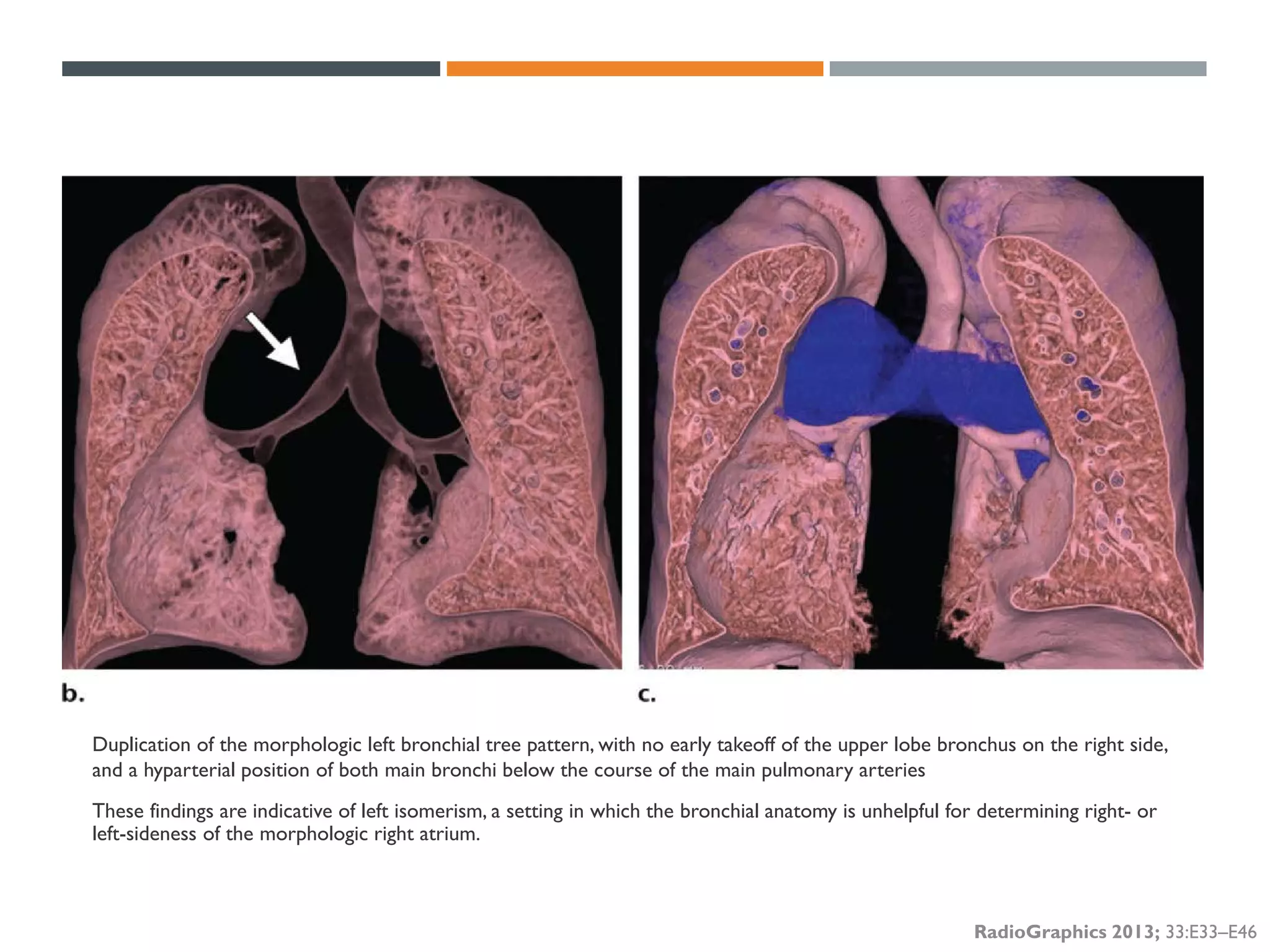 Segmental approach to Congenital Heart Disease | PDF