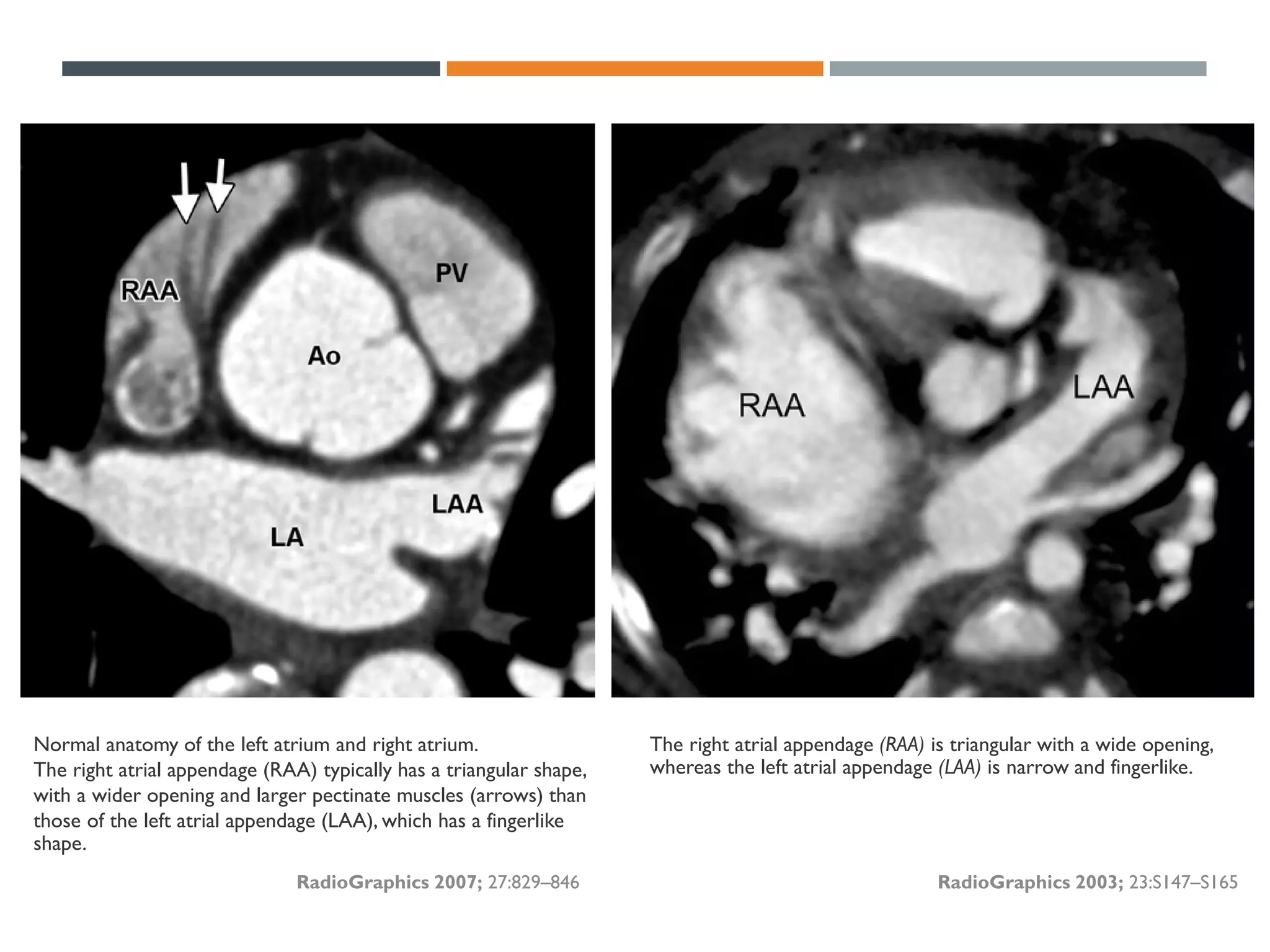 Segmental approach to Congenital Heart Disease | PDF