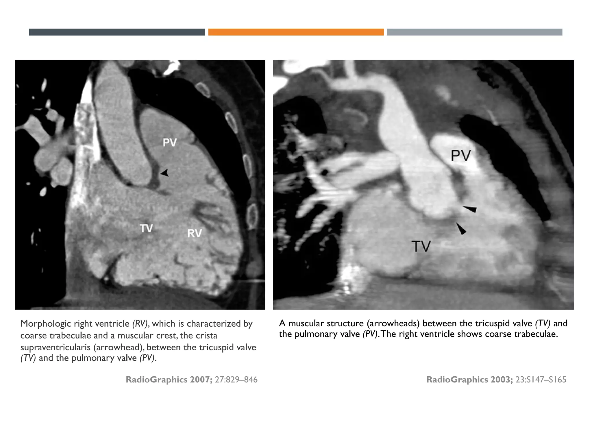 Segmental approach to Congenital Heart Disease | PDF