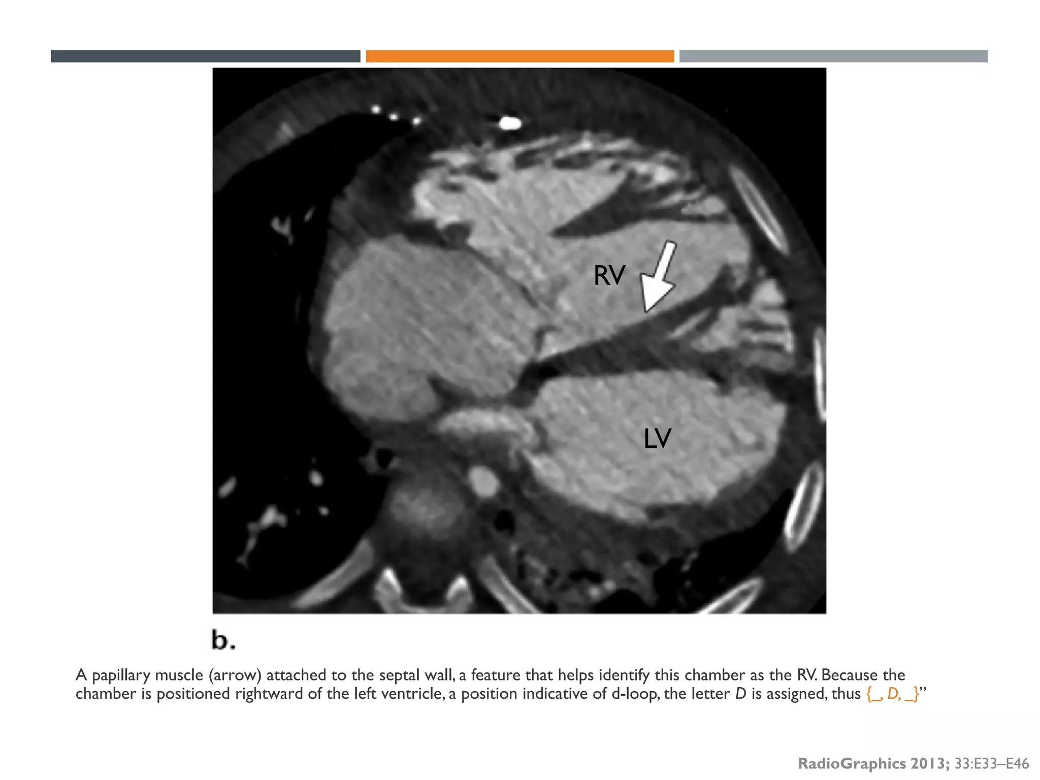 Segmental approach to Congenital Heart Disease | PDF