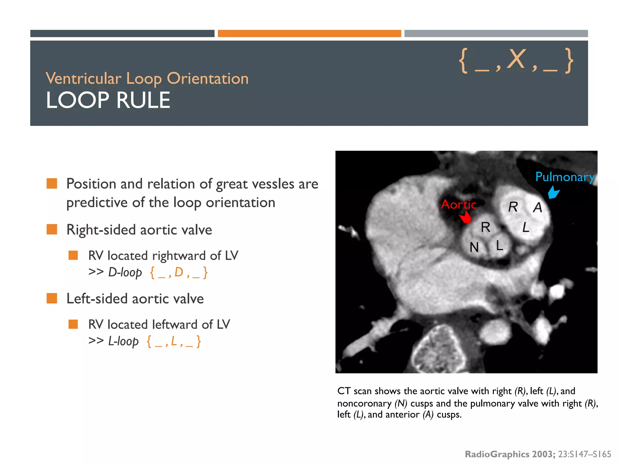 Segmental approach to Congenital Heart Disease | PDF