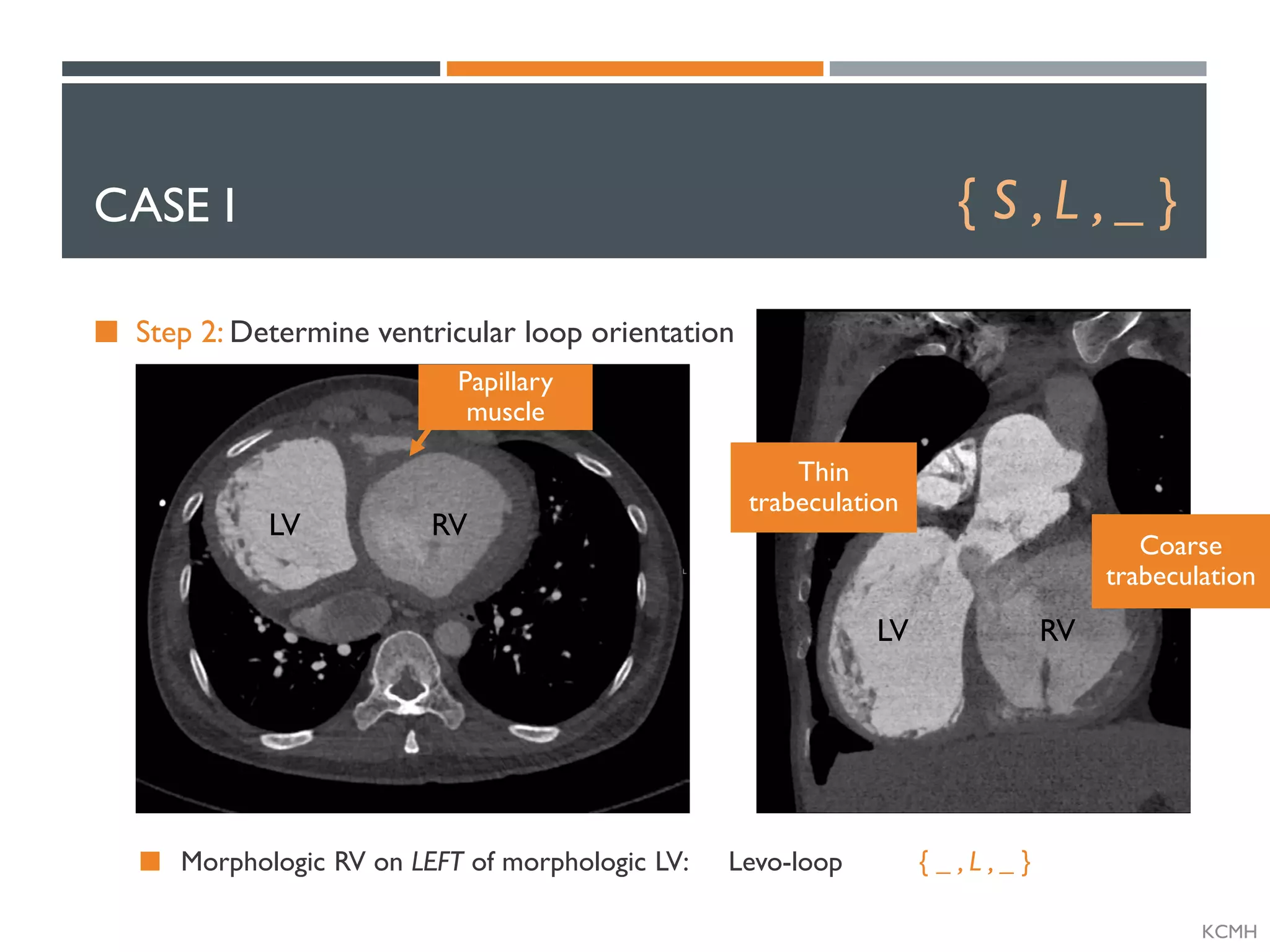 Segmental approach to Congenital Heart Disease | PDF