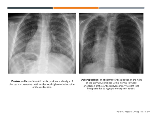 Segmental approach to Congenital Heart Disease | PDF | Heart and ...