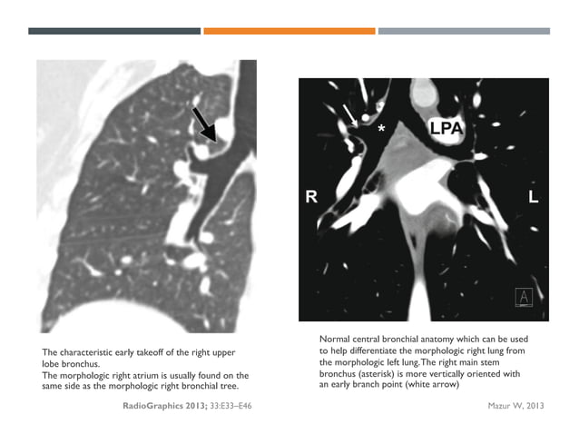 Segmental approach to Congenital Heart Disease | PDF | Heart and ...