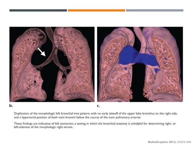 Segmental approach to Congenital Heart Disease | PDF | Heart and ...