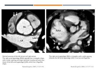 Segmental approach to Congenital Heart Disease | PDF
