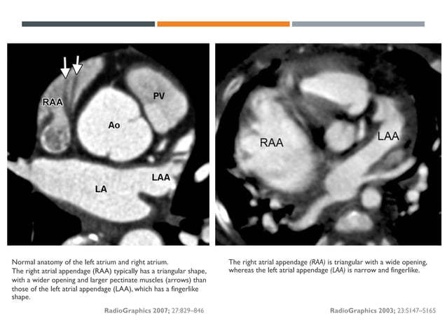 Segmental approach to Congenital Heart Disease | PDF | Heart and ...