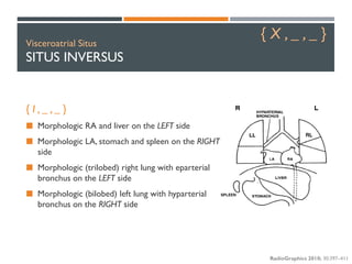 Segmental approach to Congenital Heart Disease | PDF