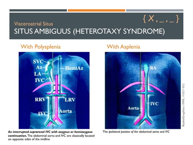 Segmental approach to Congenital Heart Disease | PDF | Heart and ...