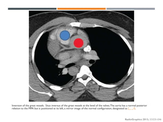 Segmental approach to Congenital Heart Disease | PDF
