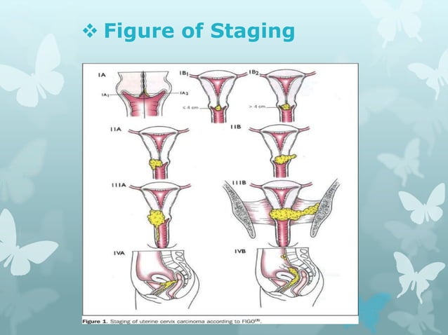 CA Cervix | PPT