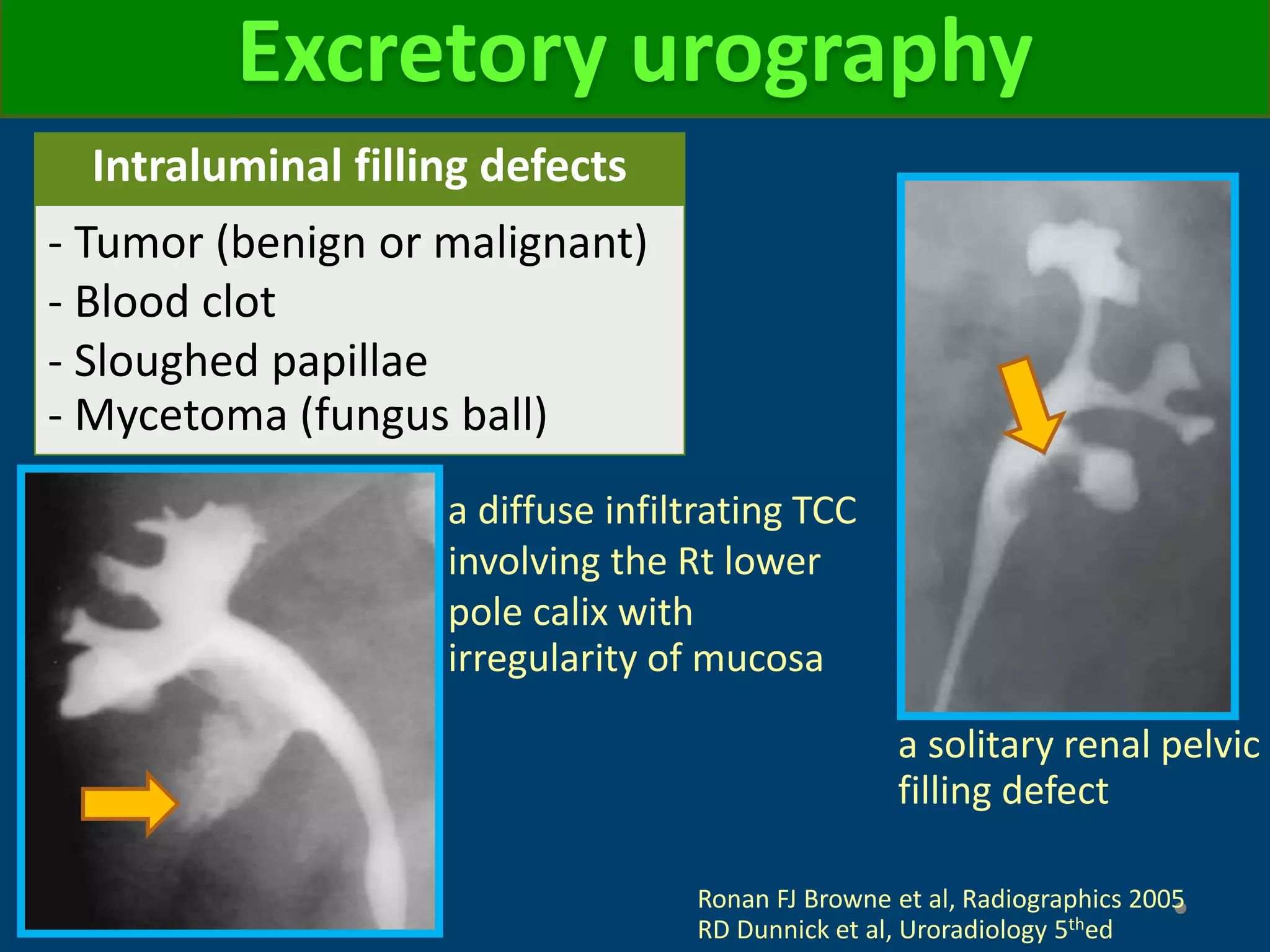 Renal mass | PPTX