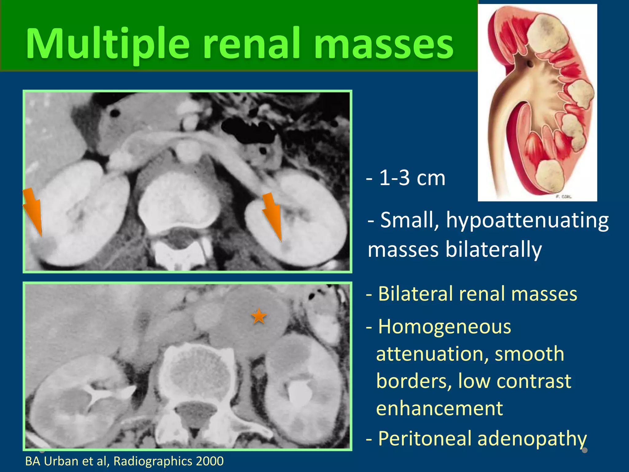 Renal mass | PPTX