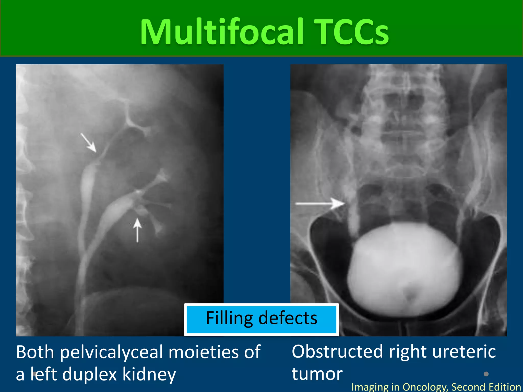 Renal mass | PPTX