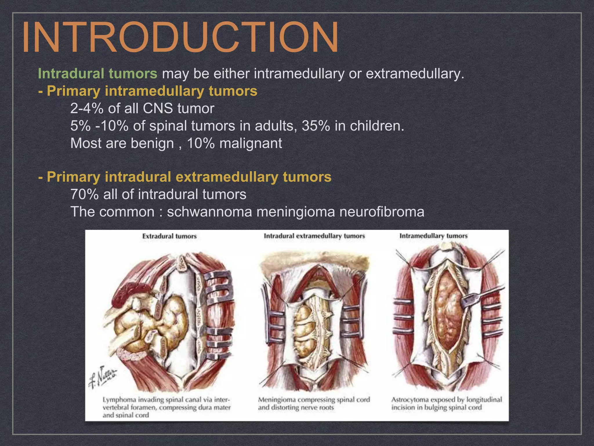 Topic review spinal cord tumor new | PPTX