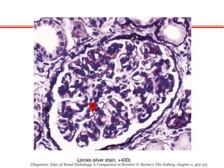 Topic scleroderma and kidney Chaken Maniyan | PDF