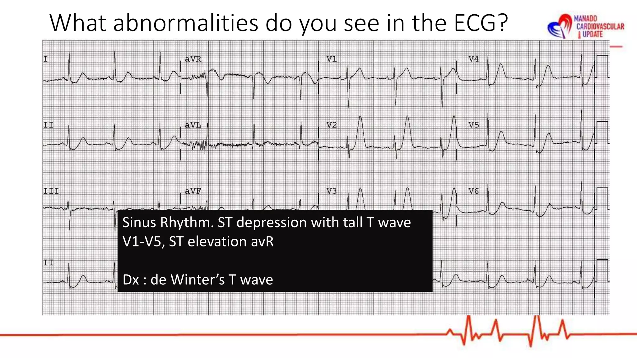 Topik 6 - ECG in clinical practica (Advanced ECG).pdf