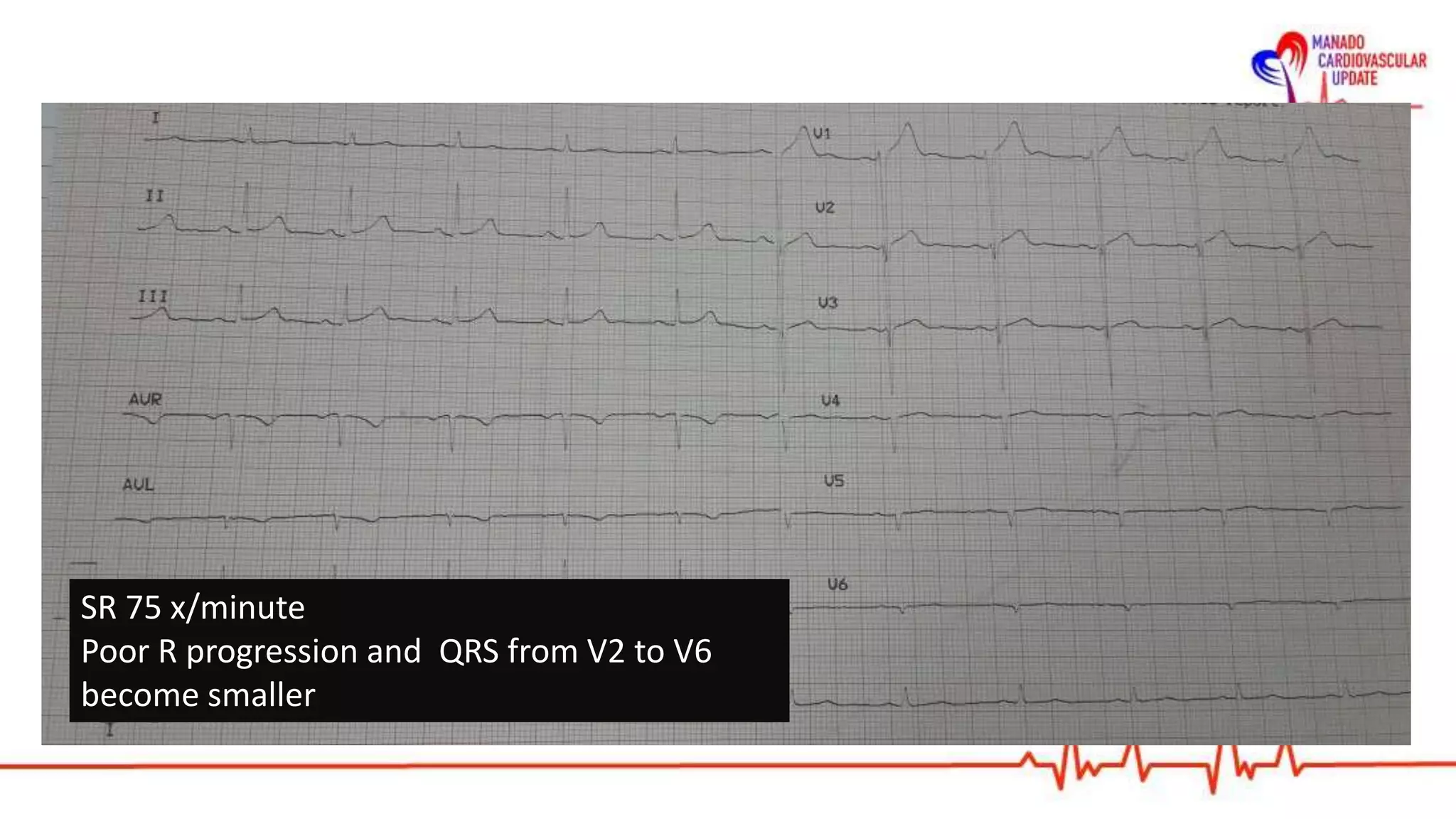Topik 6 - ECG in clinical practica (Advanced ECG).pdf